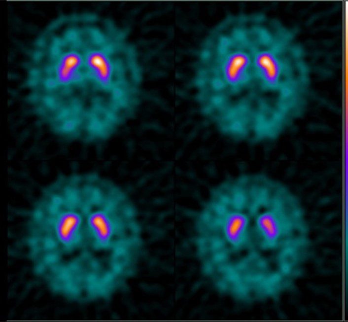 Infofiche DAT-scan - Heilig Hart Ziekenhuis Lier